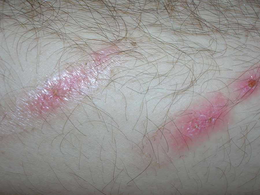 Que faire en cas de brûlure